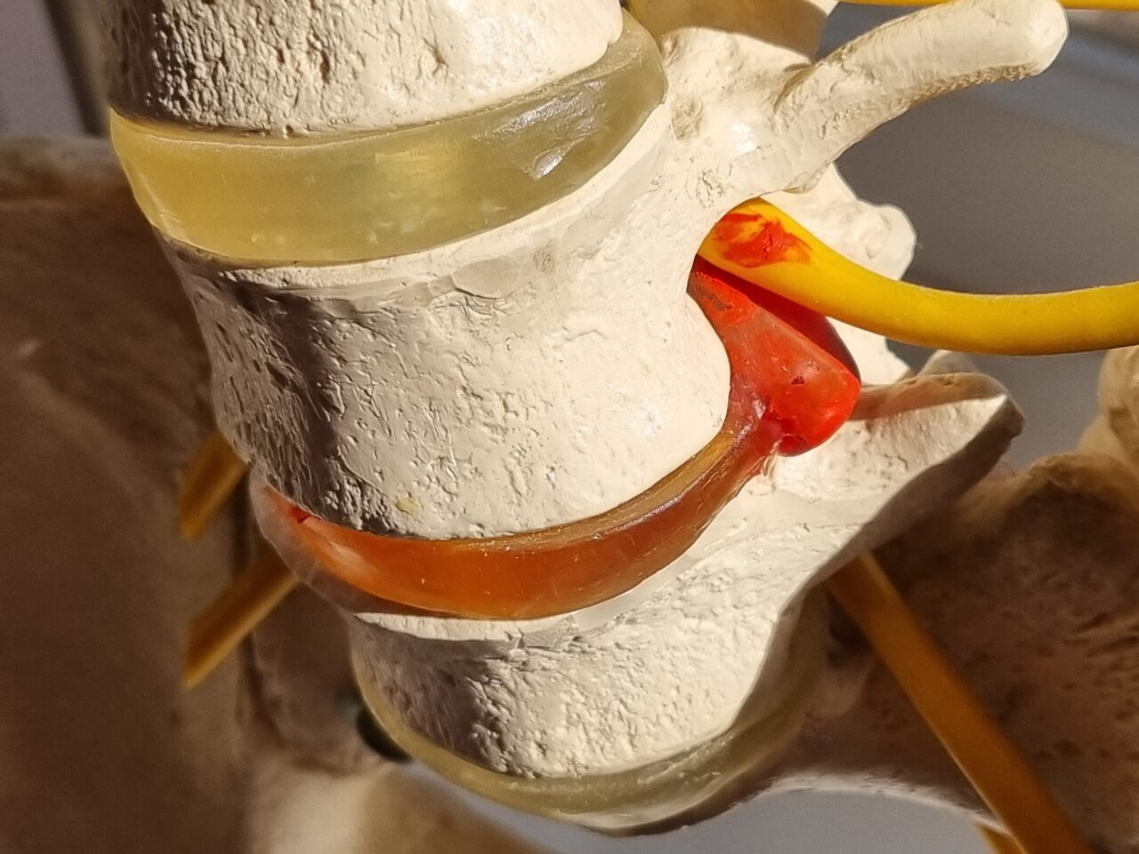 What is a 'slipped' prolapsed disc? - Theale